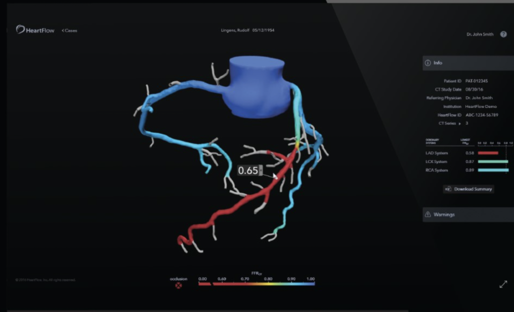 How 3D models are transforming heart care - Future Care Capital