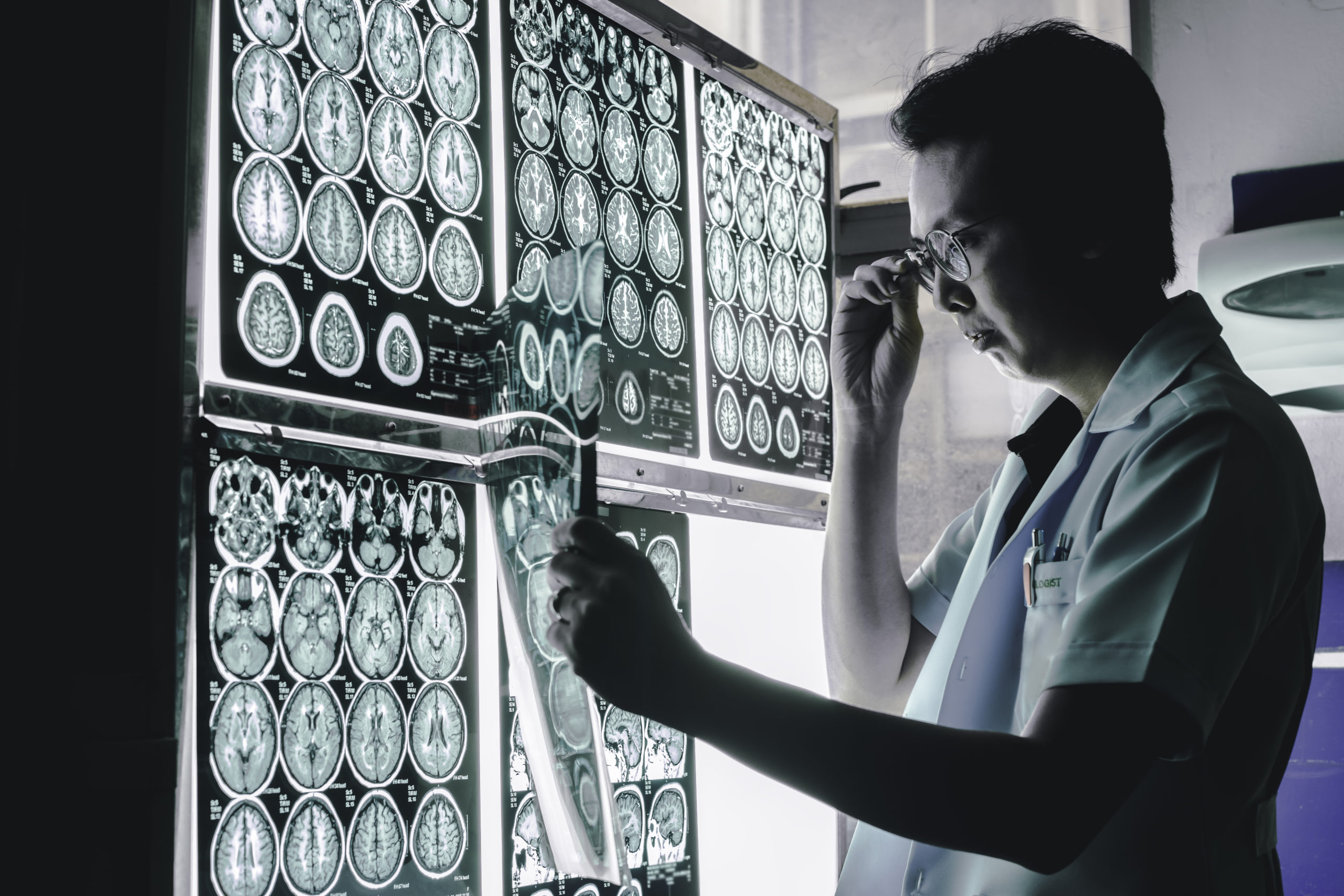 AI brain scan for dementia being trialled at Addenbrooke’s Hospital ...