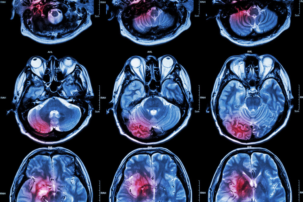 King’s College Hospital using AI to diagnose stroke patients - Future ...
